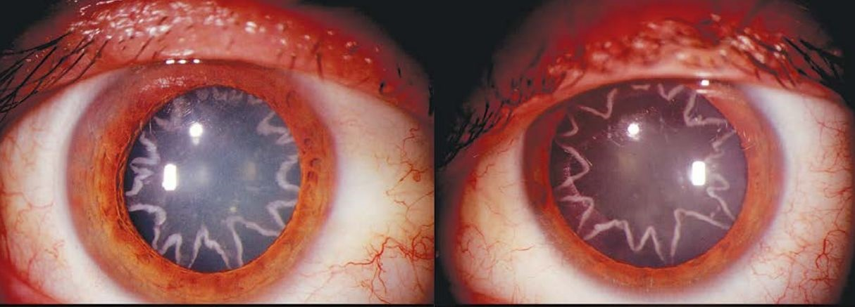 Electrician's Eyes Damaged from Shock Incident | EC&M